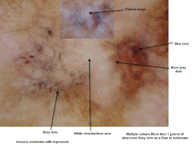 Dermoscopy Made Simple: LPLK
