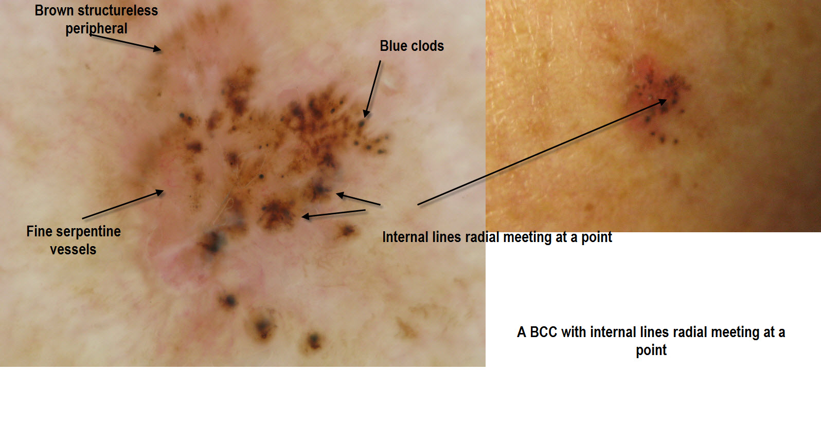 Dermoscopy Made Simple: Basal Cell Carcinoma