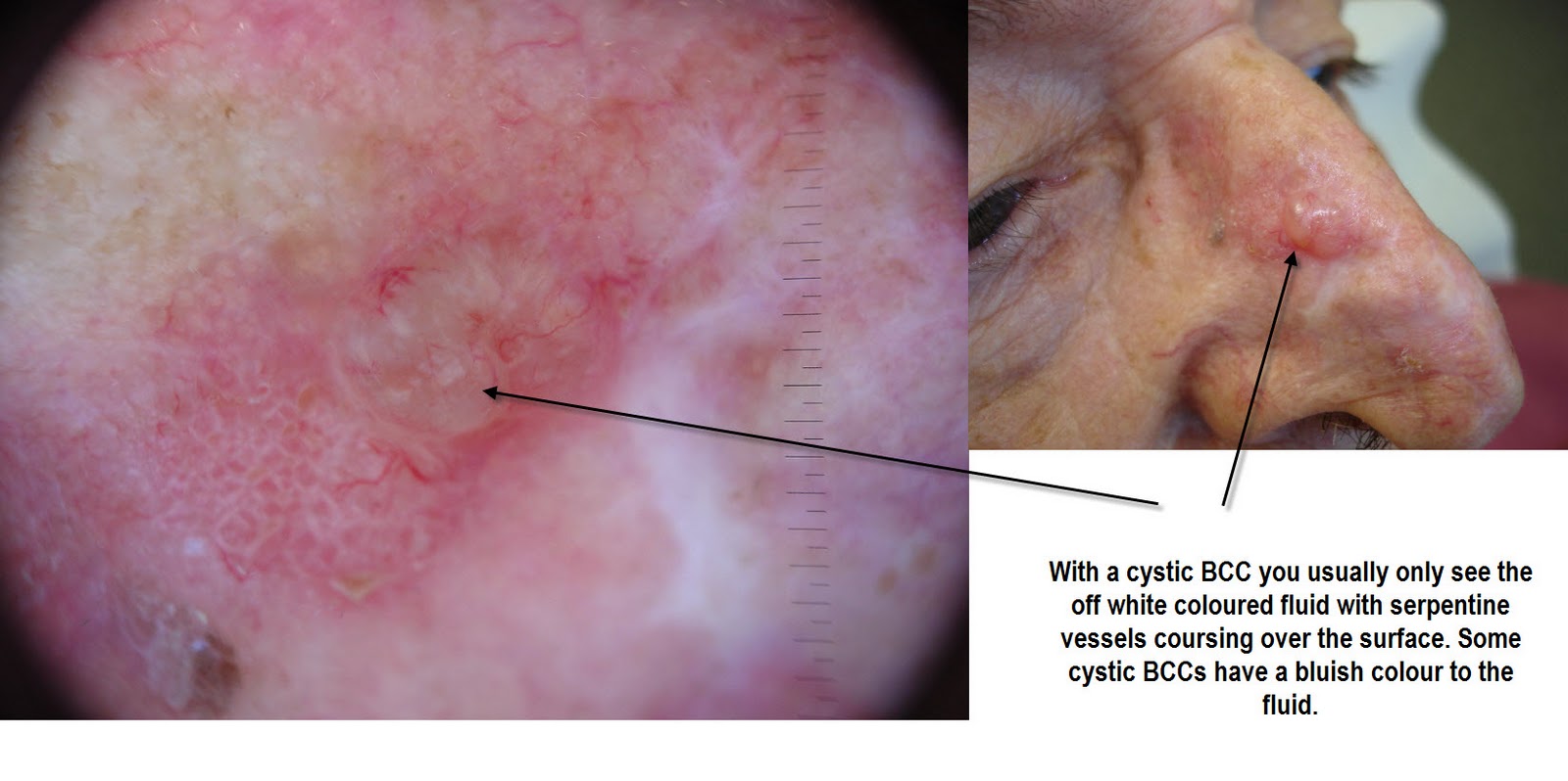 Dermatoscopy Made Simple: Basal Cell Carcinoma