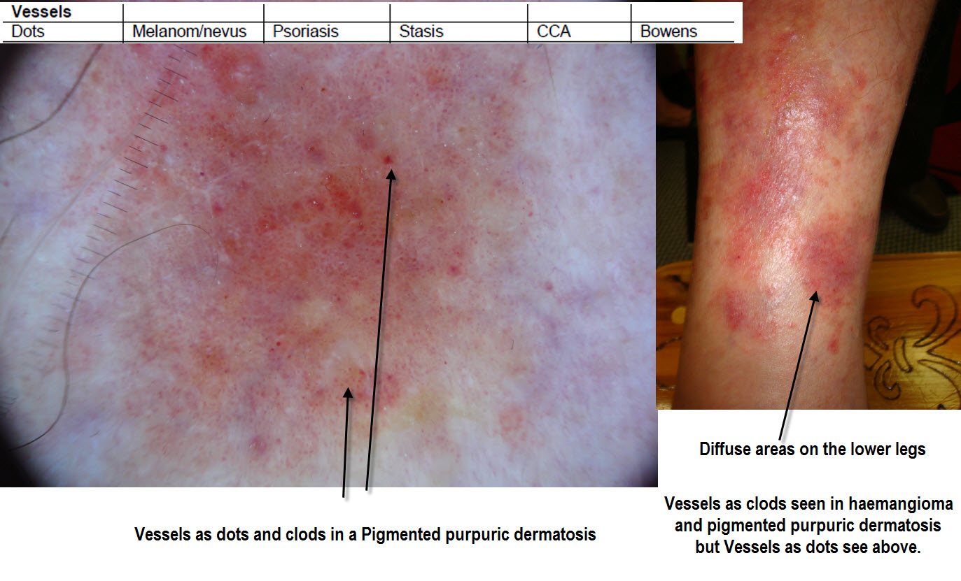Dermoscopy Made Simple: Vessels
