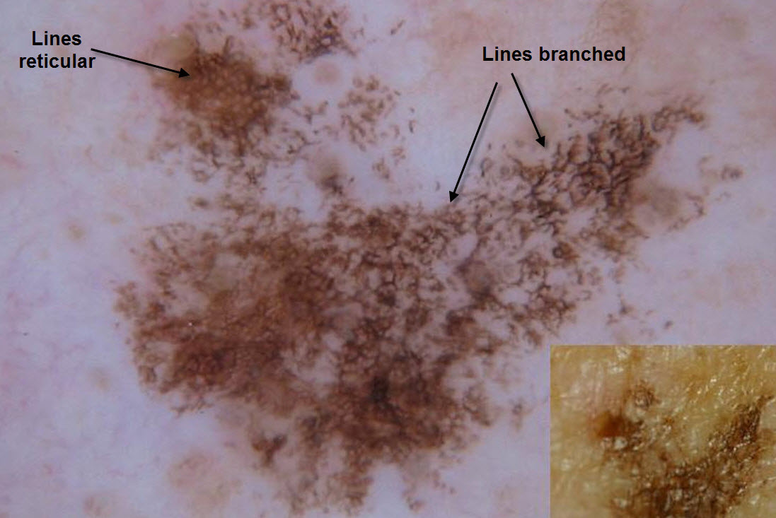 Dermoscopy Made Simple: Ink Spot Lentigo