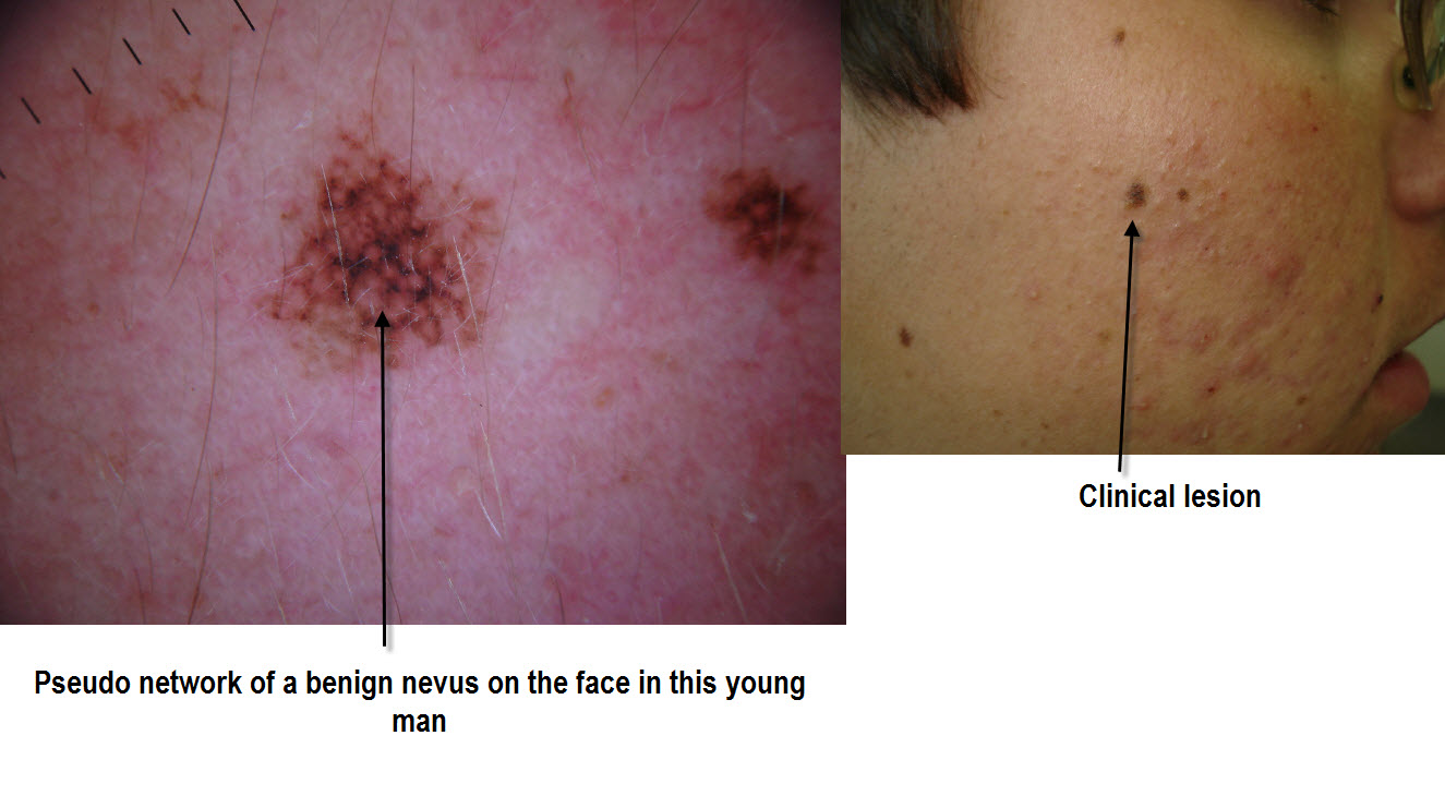 Dermoscopy Made Simple: Benign Nevus
