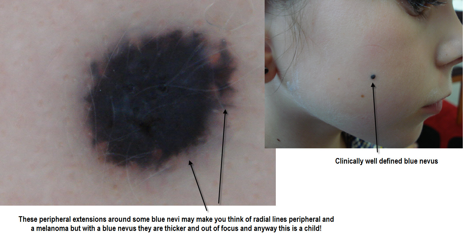 Dermoscopy Made Simple: Blue nevus