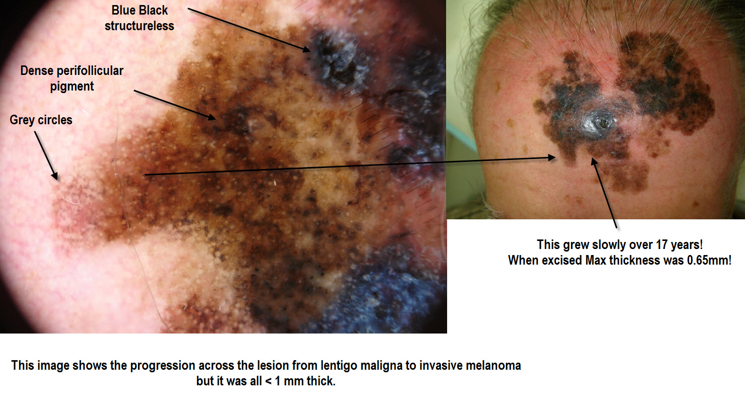 Dermoscopy Made Simple: Lentigo maligna