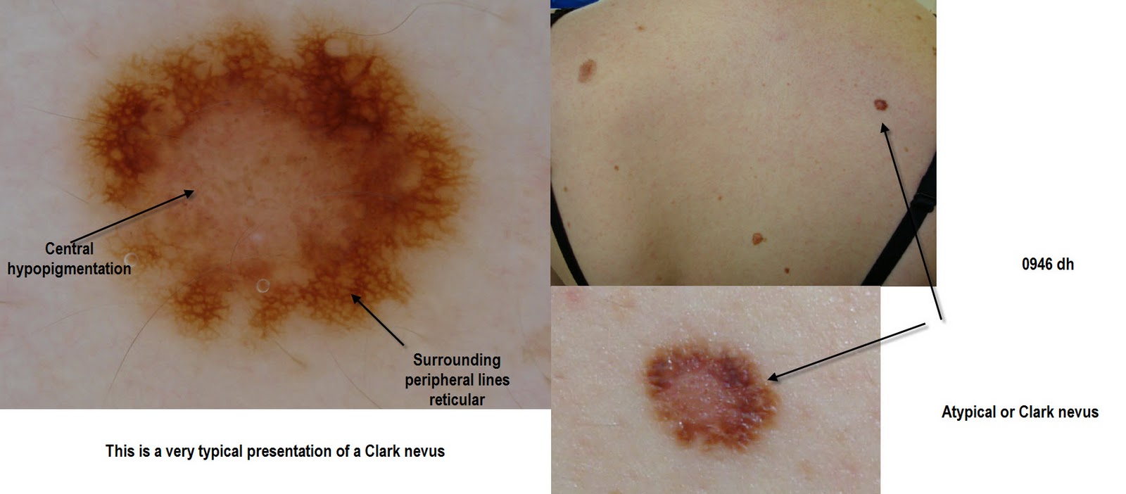Dermatoscopy Made Simple: Clark or Dysplastic nevi