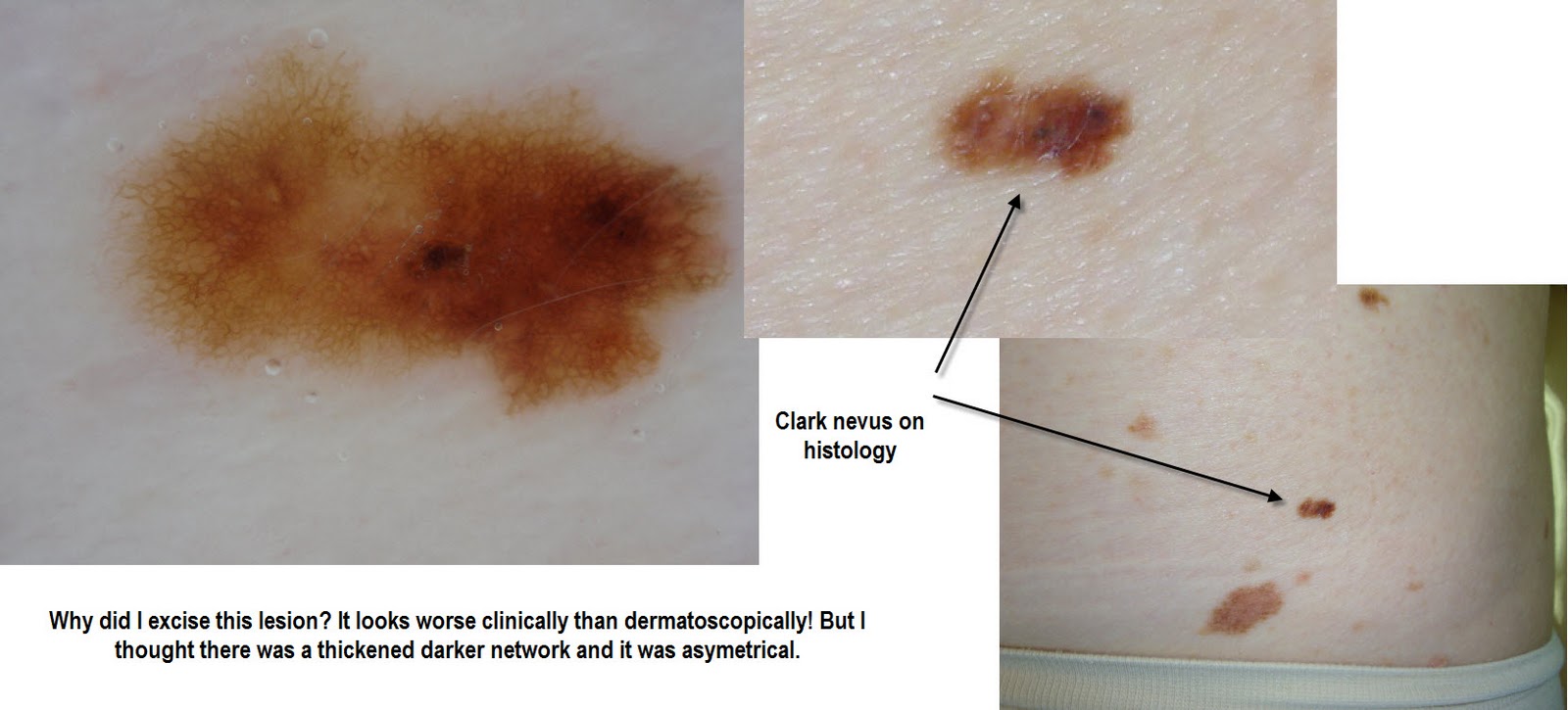 Dermatoscopy Made Simple: Clark or Dysplastic nevi