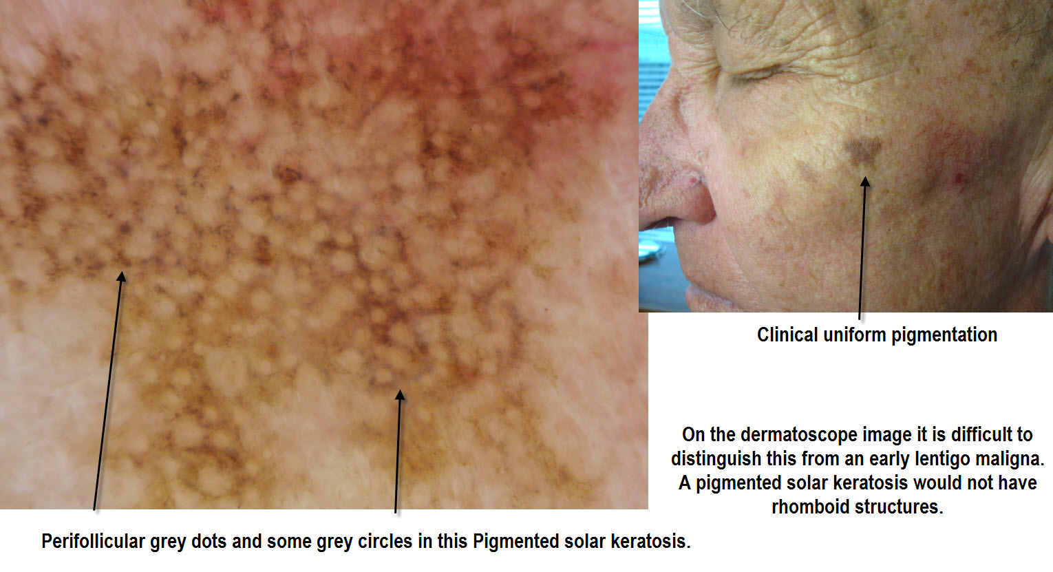 Dermoscopy Made Simple: Solar keratosis