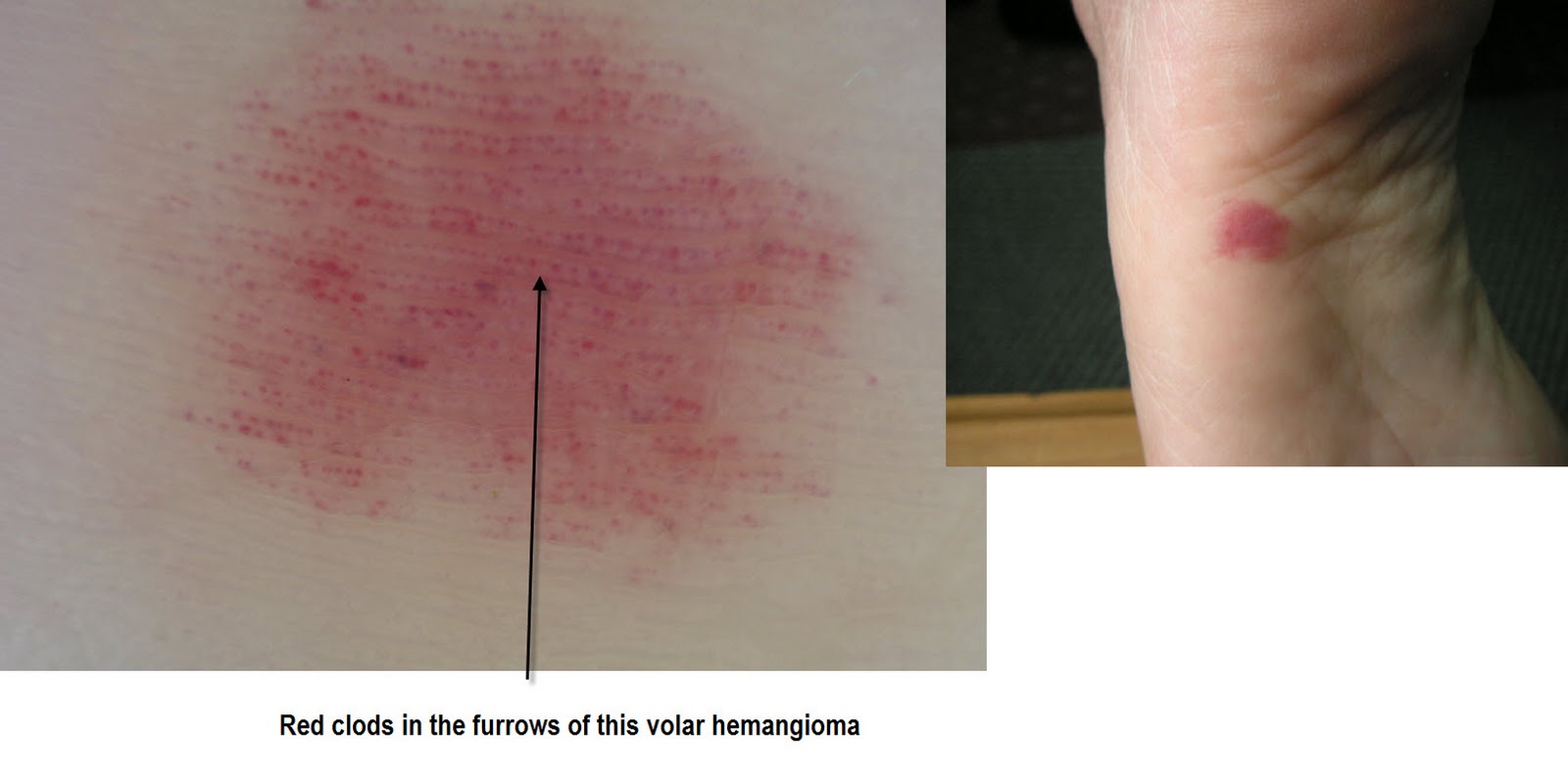 Dermoscopy Made Simple: Haemangioma and Angiokeratoma