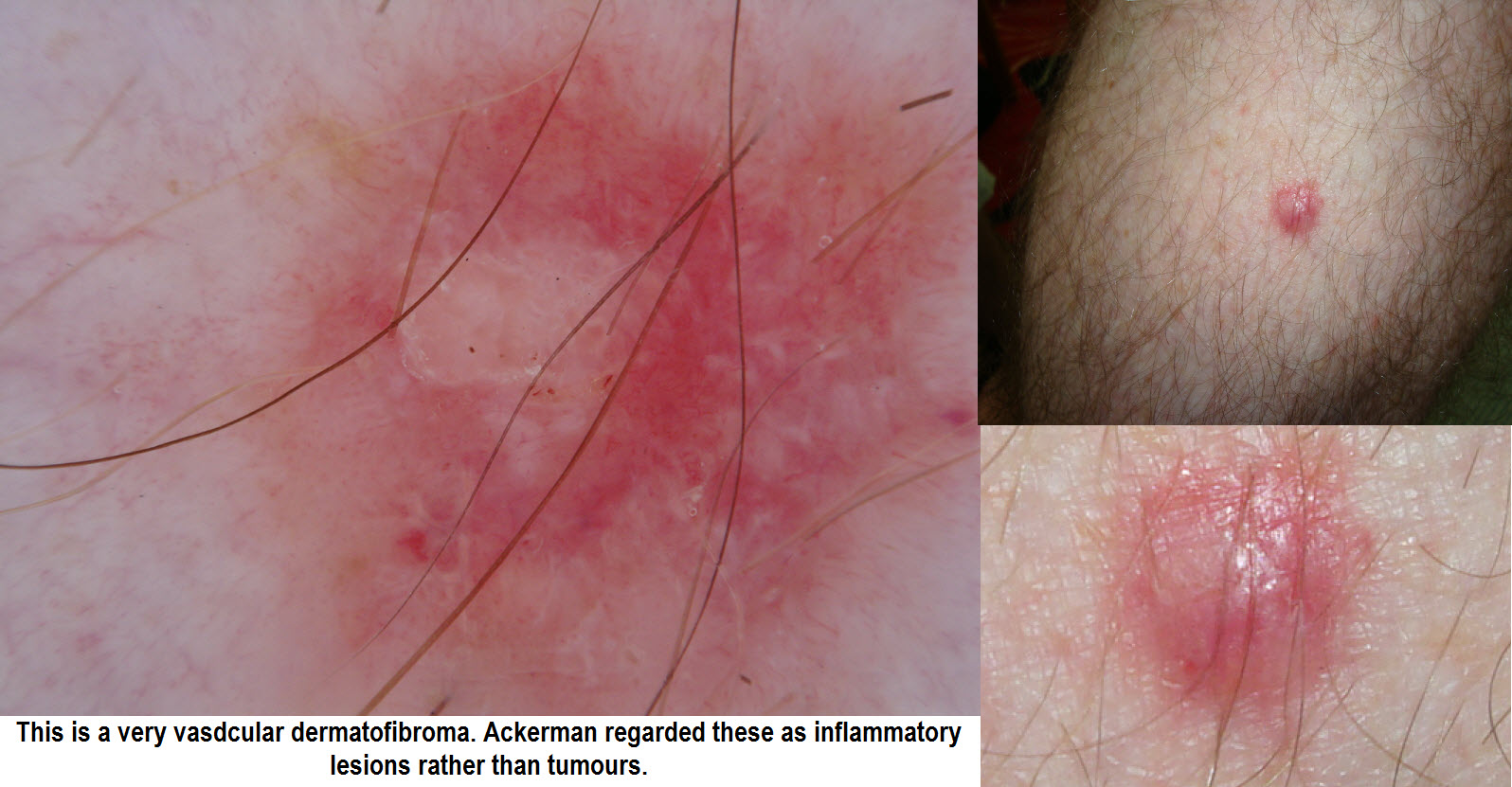 Dermoscopy Made Simple: Dermatofibroma