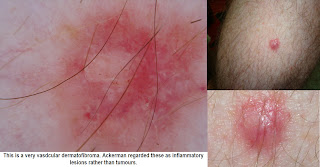 Dermoscopy Made Simple: Dermatofibroma