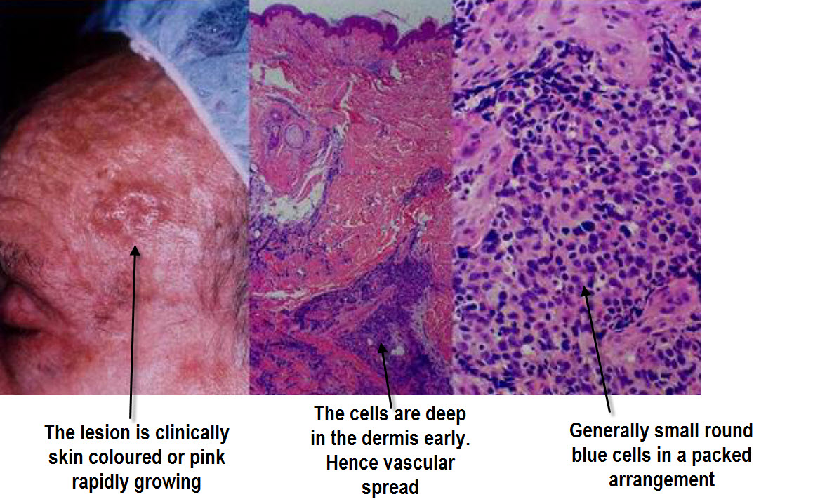 Merkel Cell Histology