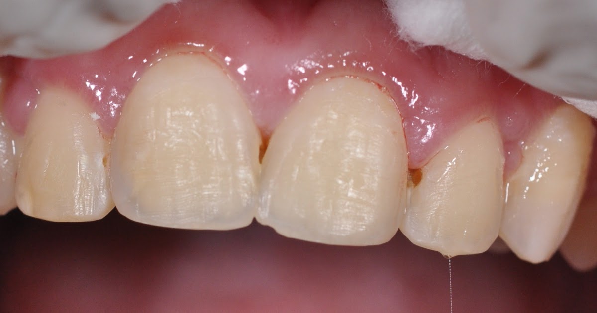 Odontología______________: Caries Interproximal
