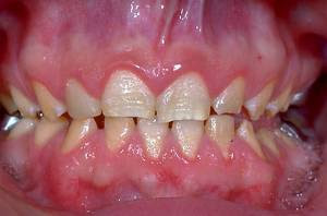 OdontoBlogger: Erosão Ácida