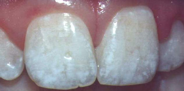 OdontoBlogger: Fluorose Dentária