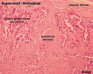 Patologia ENFoco: Amiloidose