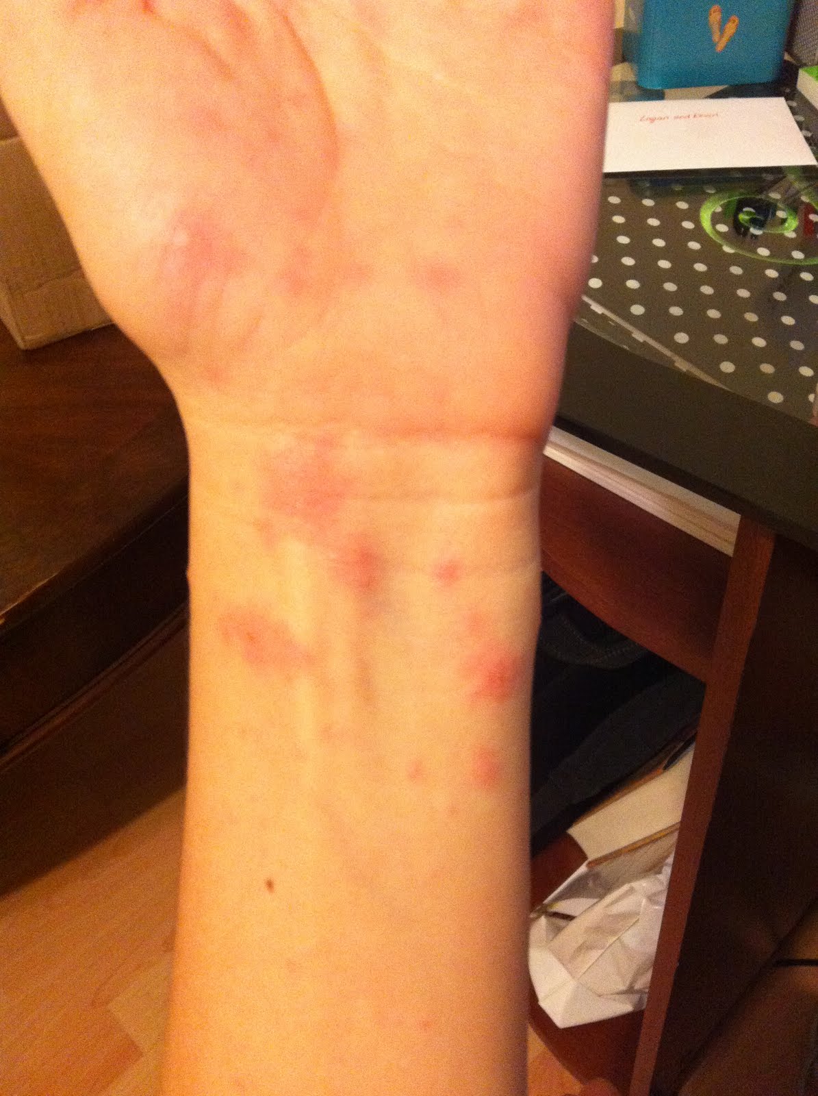 Wrist: Wrist rash