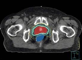 Prostate Cancer Journal: Intensity Modulated Radiation Therapy (IMRT)