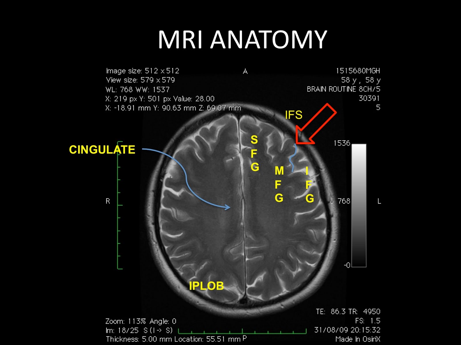 Centrum semiovale function