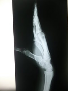 Rayos-5 ;p: MANO PROYECCION LATERAL (LATEROMEDIAL EN EXTENSION)