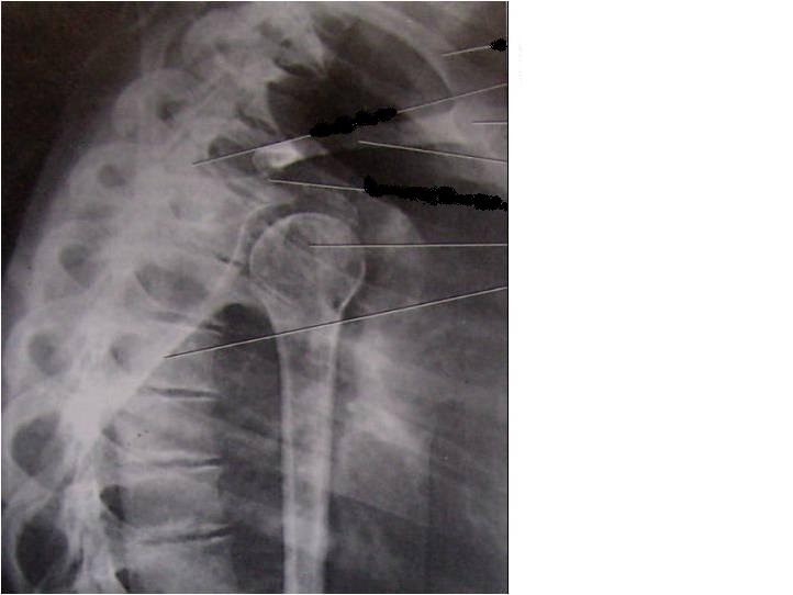 Rayos-5 ;p: HOMBRO PROYECCION LATERAL TRANSTORACICA (METODO DE LAWRENCE)