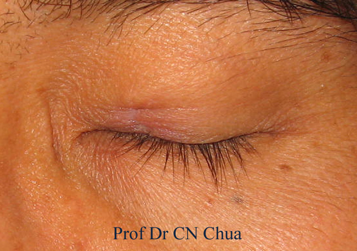 Eyelid Surgery by Prof Dr CN CHUA 蔡鐘能: How I Managed the Lost Eyelashes