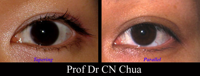 Eyelid Surgery by Prof Dr CN CHUA 蔡鐘能: What Type of Double Eyelid Do ...