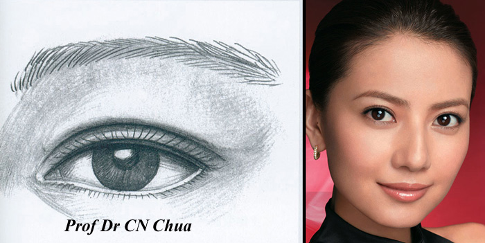 Eyelid Surgery by Prof Dr CN CHUA 蔡鐘能: What Type of Double Eyelid Do ...