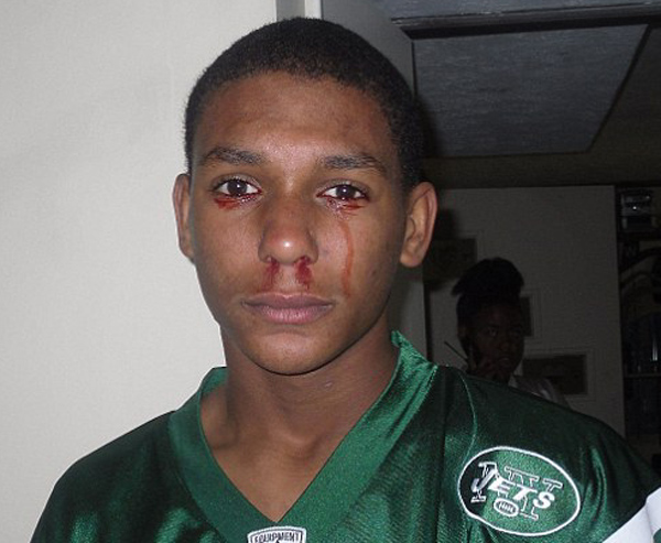 Eyelid Surgery by Prof Dr CN CHUA 蔡鐘能: People Who Shed Bloody Tear ...