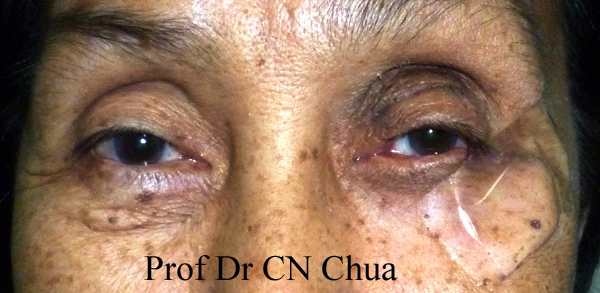Eyelid Surgery by Prof Dr CN CHUA 蔡鐘能: Power of the Tapes - What to Do ...