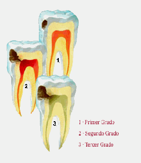 CARIES DENTAL: Síntomas y Clasificación Operatoria