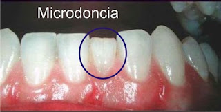 La Foseta Cariada: Alteraciones del tamaño de los dientes