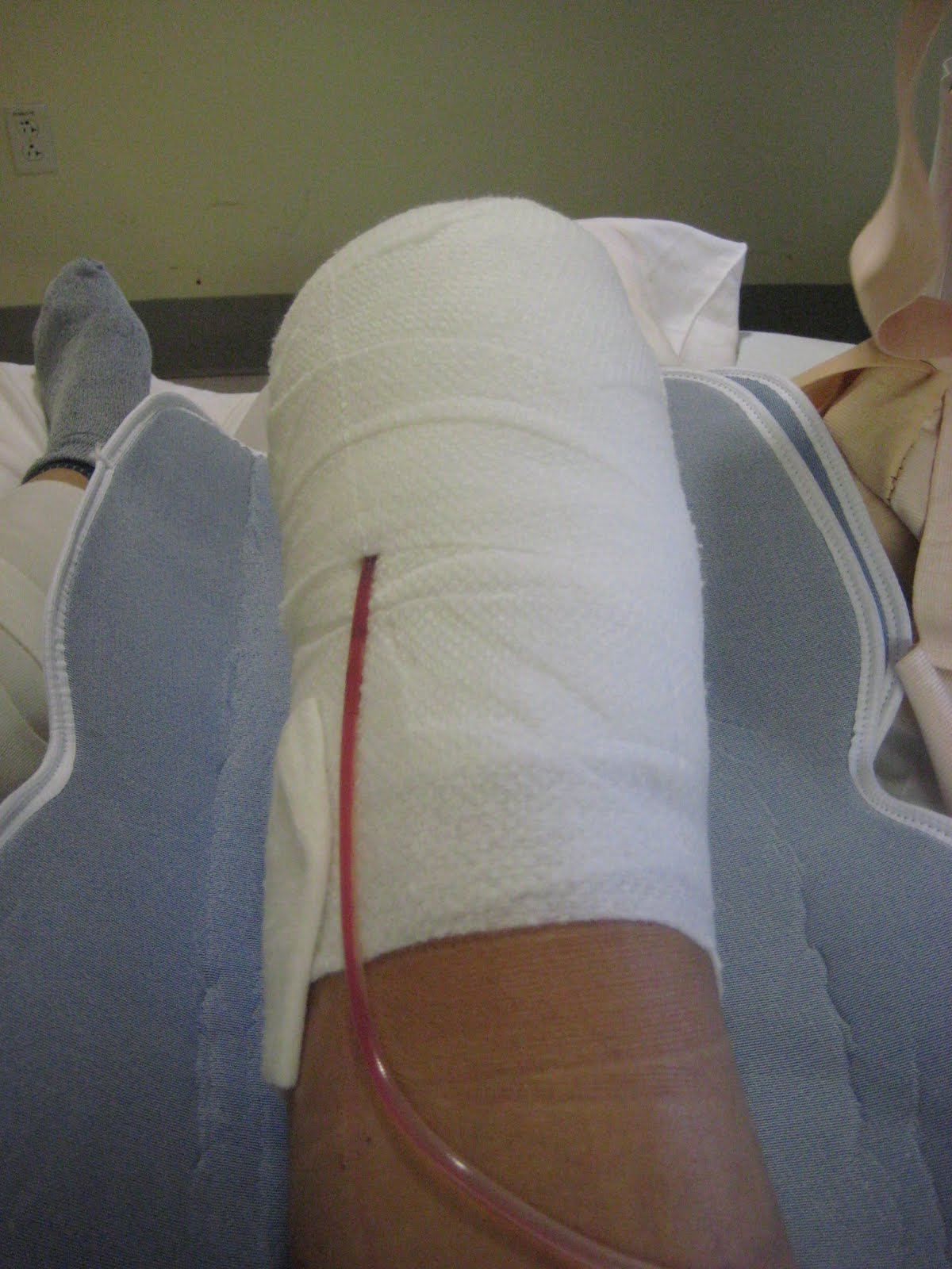 Anne's Great Fall Wound Pics: My New Limb