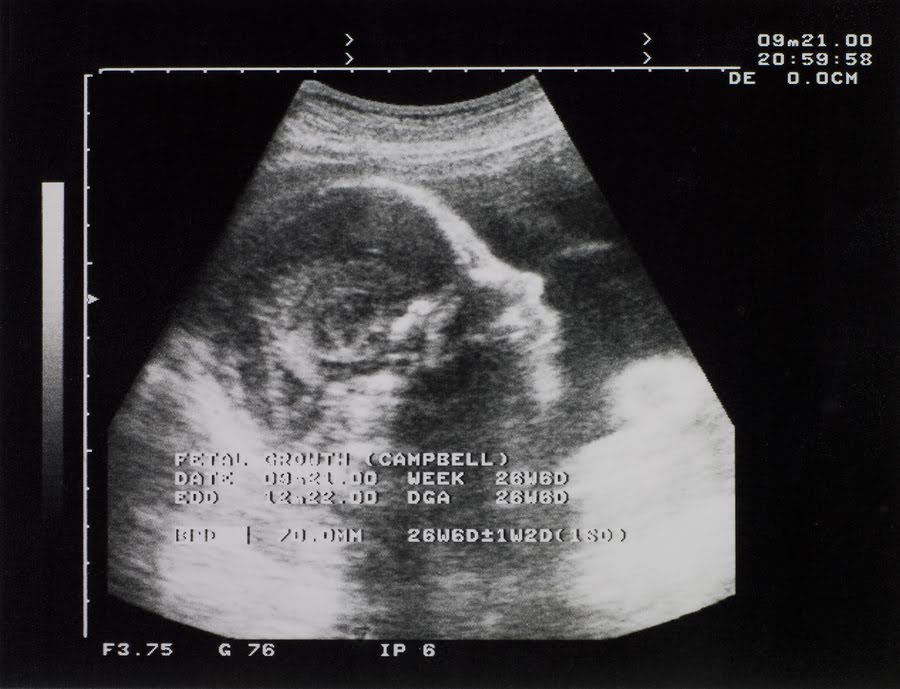 Etapas del Embarazo Semana a Semana: Semana 36