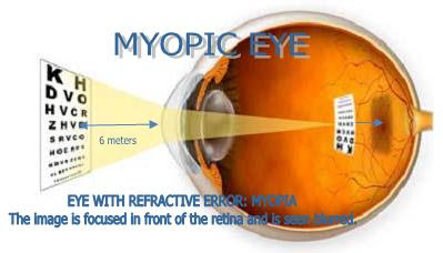 Exploring the world of vision: Refractive disorders: Myopia or ...