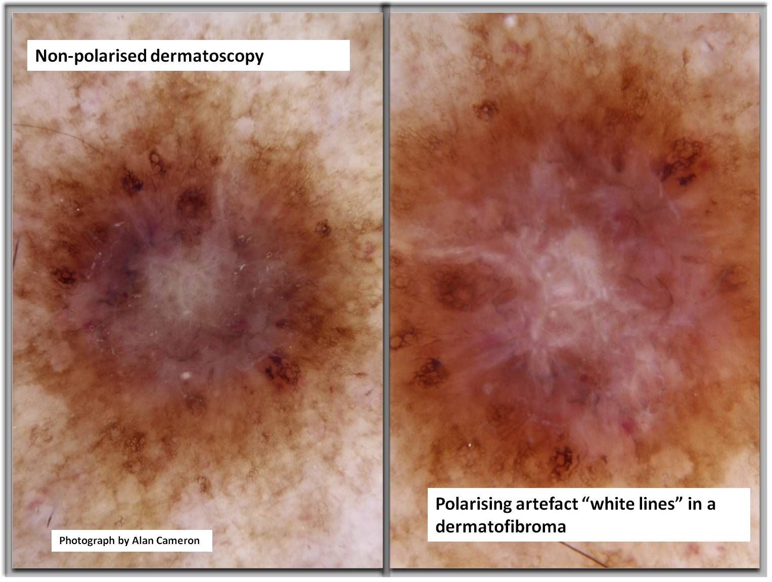 Introduction to Dermatoscopy