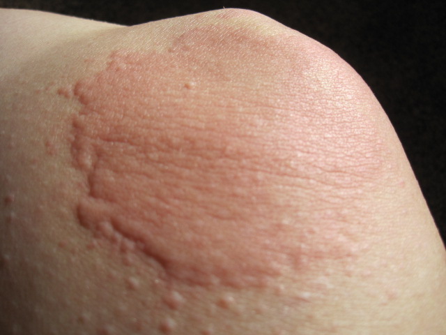 A Joy Full Home: Erythema Multiforma (Not Hives)