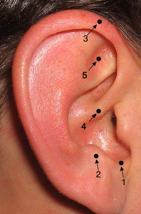 Integrative Medicine for NW Arkansas: Battlefield Acupuncture: A quick ...