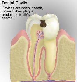 Dickson Pediatric Dentistry, PLLC: What Is A Cavity??