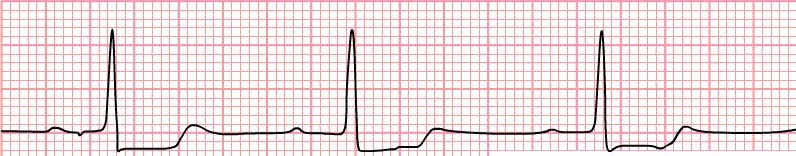 Blog do ECG: BAV DE 1º GRAU