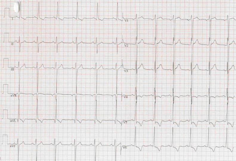 Blog do ECG: Traçado de SVE