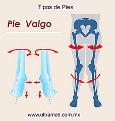 PIE VALGO TRATAMIENTO DE FISIOTERAPIA ~ Fisioterapia