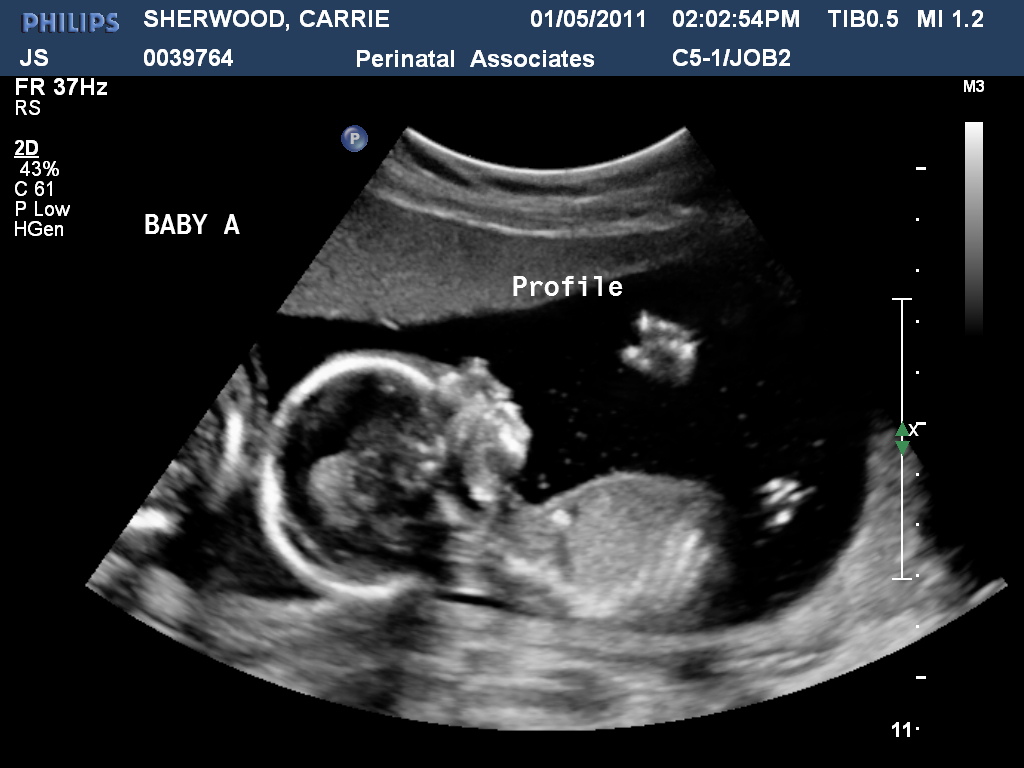 Life with the Sherwoods: 17 1/2 week ultrasound