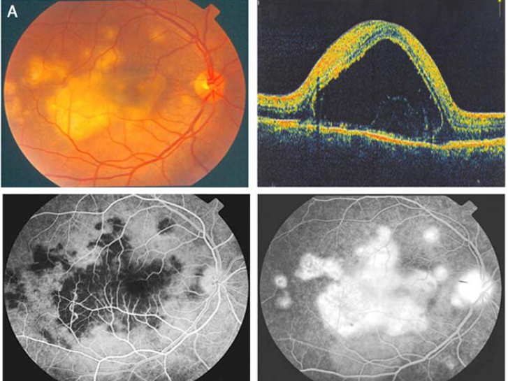 Ophthalmology مدونة السنا: Tuberculous Uveitis