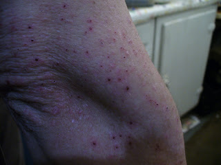 Bed Bug Bites Linear Pattern | Moreoo