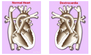 Dextrocardia | Paramedicine 101