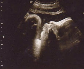we can dig it: 39 week ultrasound