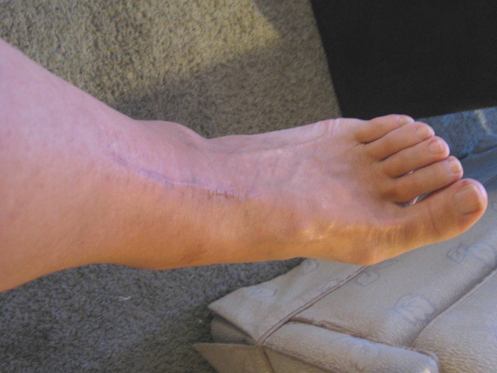 Total Ankle Replacement Surgery: My Experience: PICTURES AT 11! CHAPTER ...