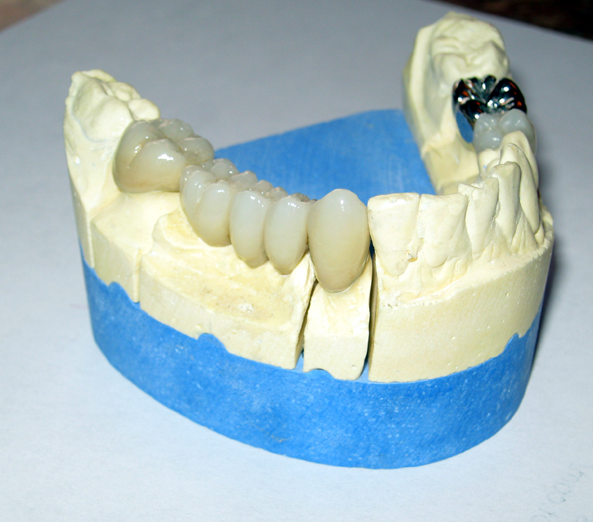 Préci-Dent: BONDED BRIDGE COMPOSITE CROWN AND METAL CROWN