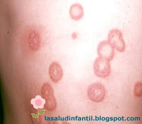 La salud infantil: Las micosis en verano