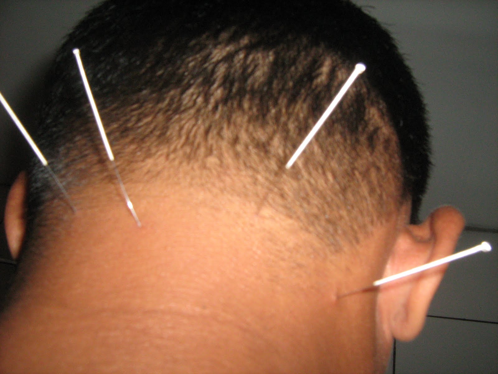 GALERI TERAPI AKUPUNKTUR MEDAN: Akupunktur Kaku Leher